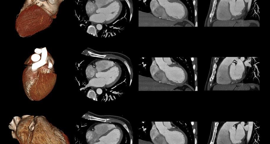 Tac o coronarografia per studiare le arterie del cuore? - la Repubblica