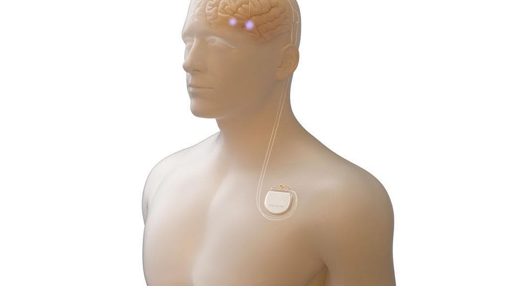 Tremore da Parkinson più controllato con stimolazione cerebrale - la ...
