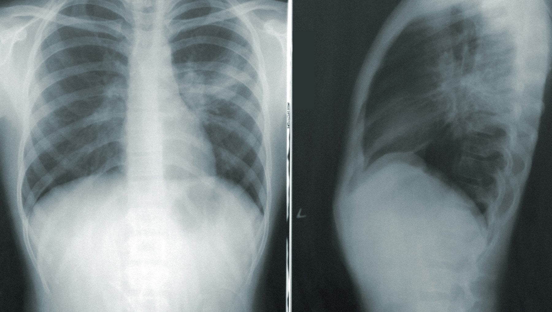 Tumori, messa a punto una nuova tecnica per rimuovere lesioni polmonari ...