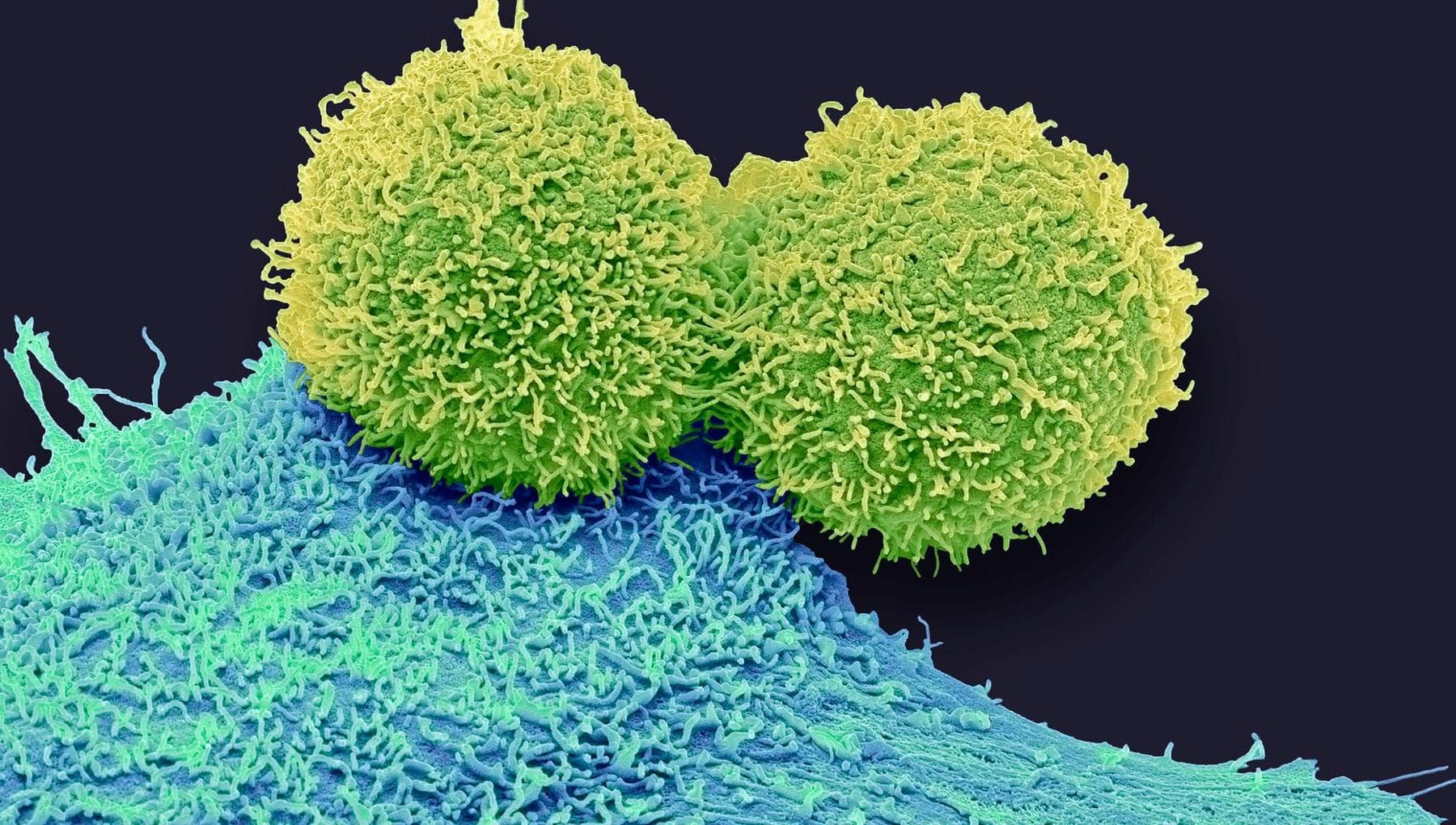 Tumore al seno, così la viscosità influenza la capacità delle cellule ...