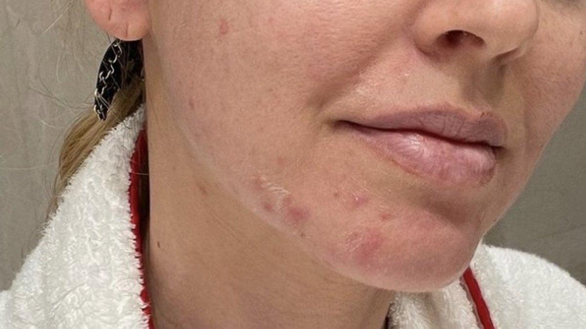 Chiara Ferragni mostra su Instagram lo sfogo cutaneo sul suo viso ...